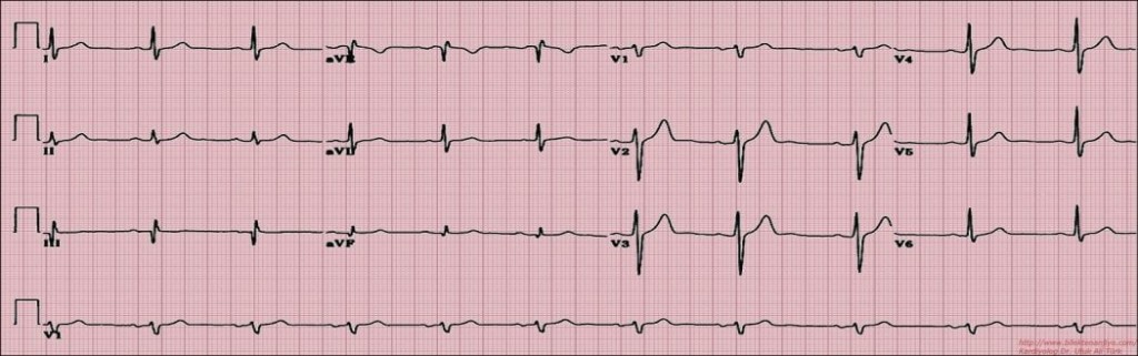 EKG – Bilekten Anjiyo